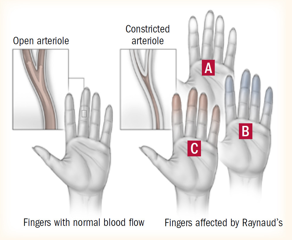 Φαινόμενο Raynaud - Emedi.gr - Πρόληψη Υγείας